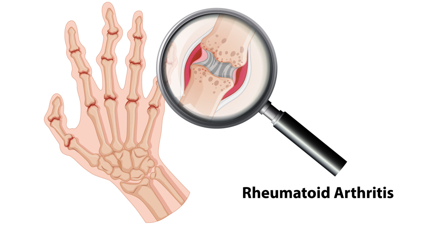 Rheumatoid Arthritis (RA): Symptoms, Causes, and Diagnosis