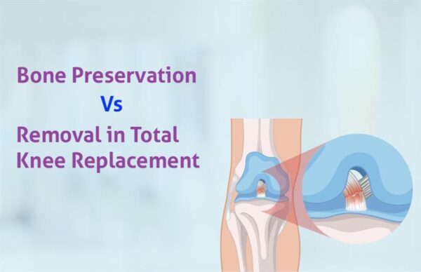 Bone Preservation vs. Removal in Total Knee Replacement